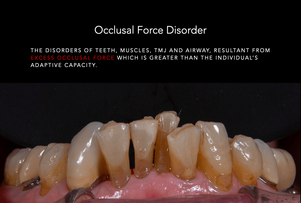 擺脫咬合板！電腦咬合分析輔助顳顎關節症候群治療－丰采美學牙醫診所